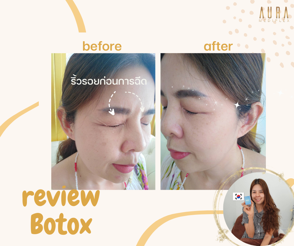 BOTOX – Auramed Clinic